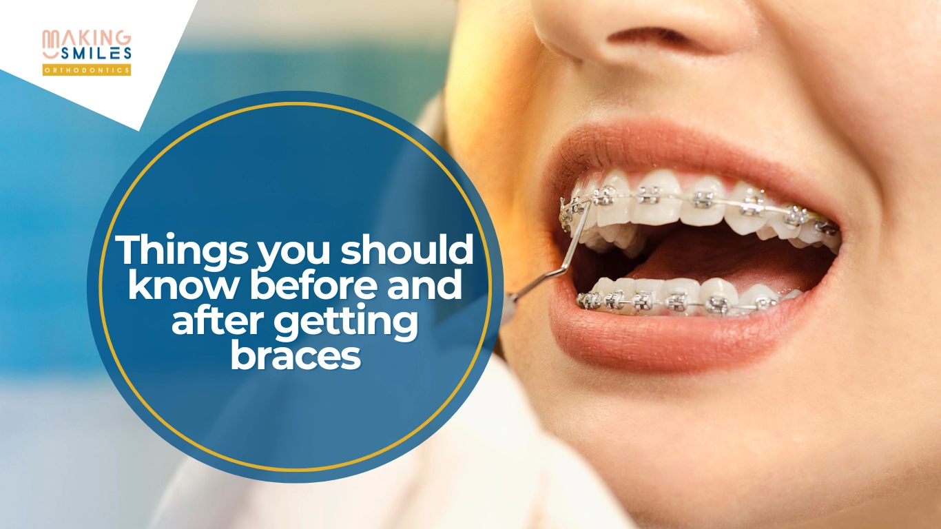 Things You Should Know Before and After Getting Braces